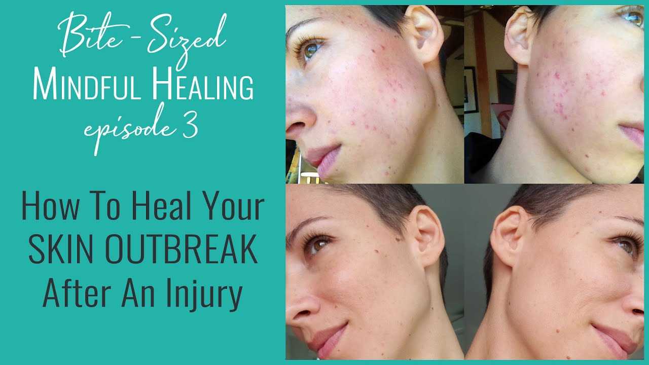 How To Heal Your Skin Outbreak After An Injury - Bite-Sized Mindful ...