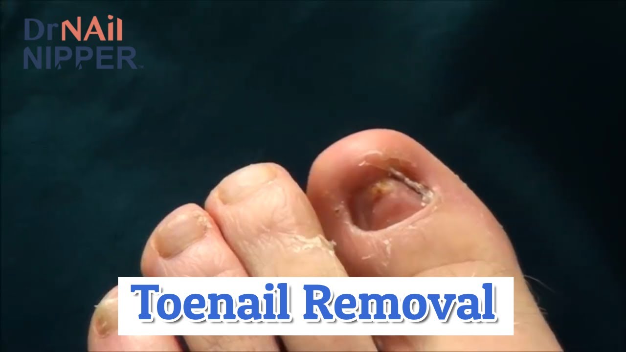 For our members... Toenail Removal - YouTube