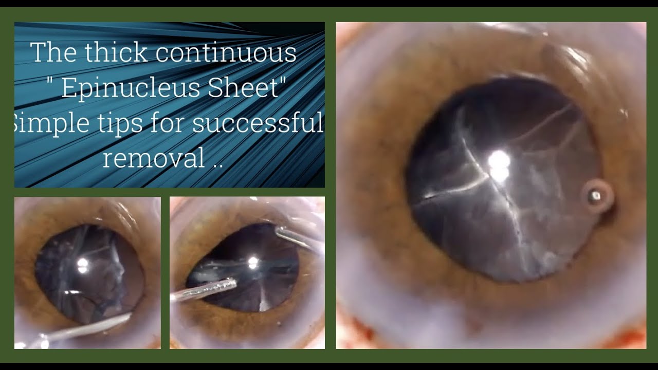 The Thick troublesome sheet of Epinucleus - Simple tips for its easy ...