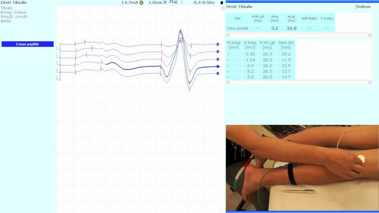 Réflexe de Hoffmann (racine S1) - YouTube
