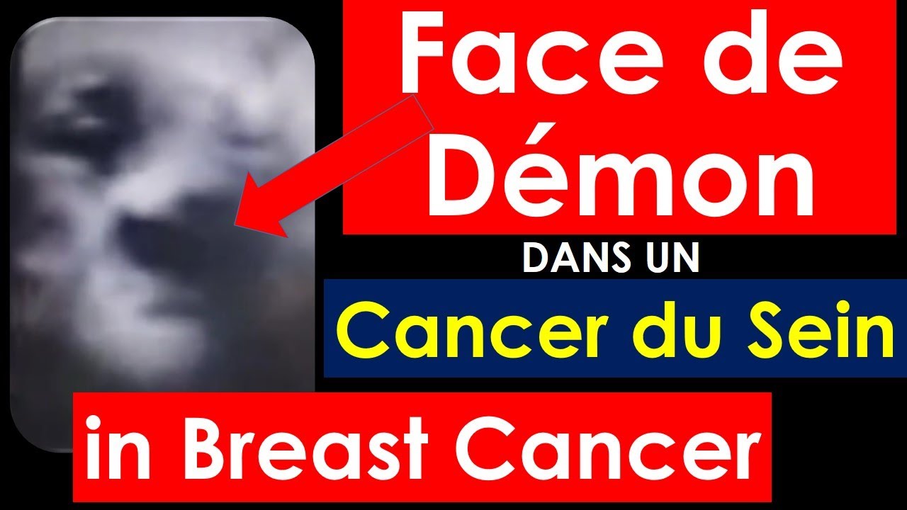 Face de Démon dans un Cancer du Sein/ Demon's Face in Breast Cancer ...