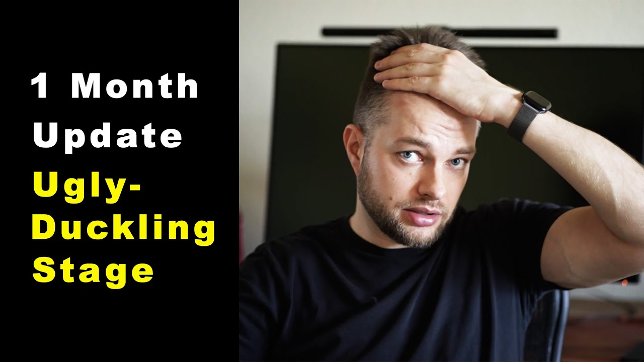 1 Month Progress Following Hair Transplant Procedure 2K Grafts at ...