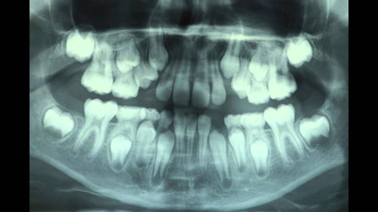 Canine Eruption Sequence - YouTube