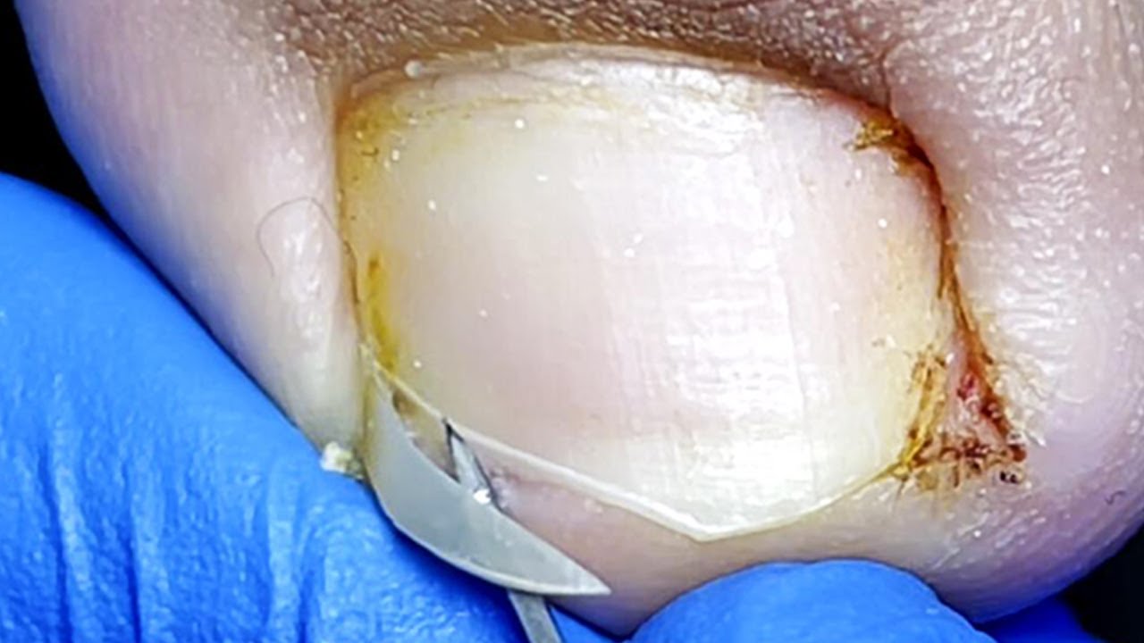 How to solve the small ingrown toenail at the front of the toenail ...