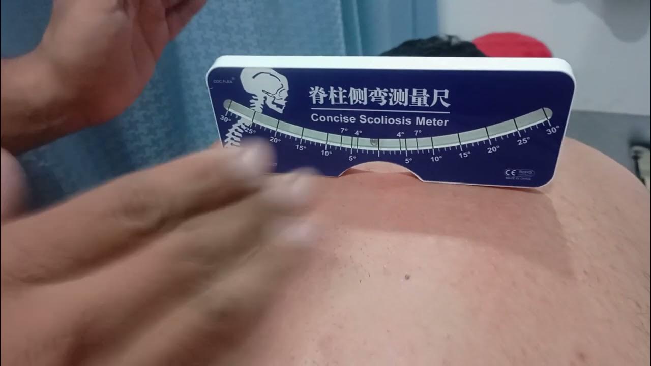 Scoliometer Use Youtube