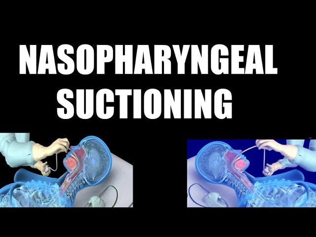 Nasopharyngeal Suctioning New NMC TOC 2022 Nasopharyngeal Suction