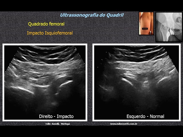 Ultrassonografia Sindrome Do Piriforme Paincare Síndrome Do