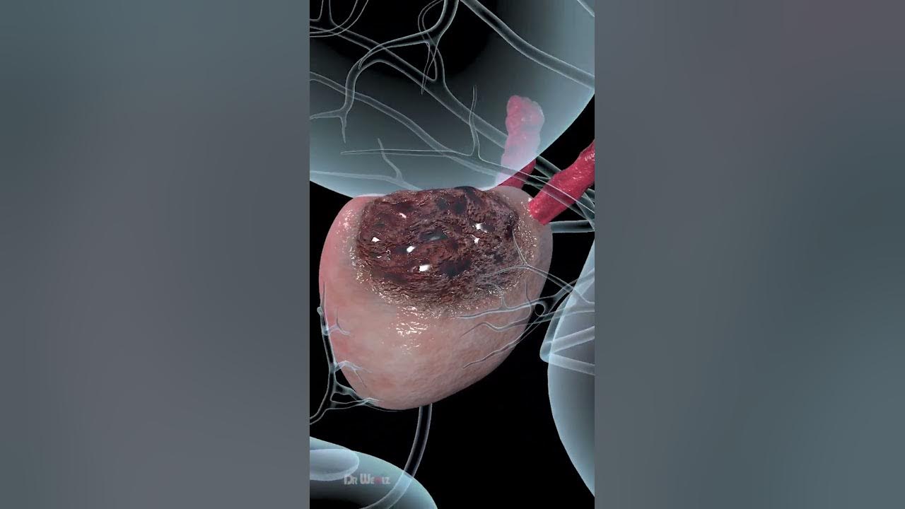 Prostate Cancer Explained Animation Youtube