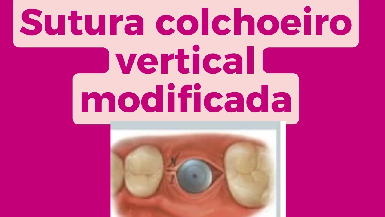 Sutura colchoeiro vertical modificada - YouTube