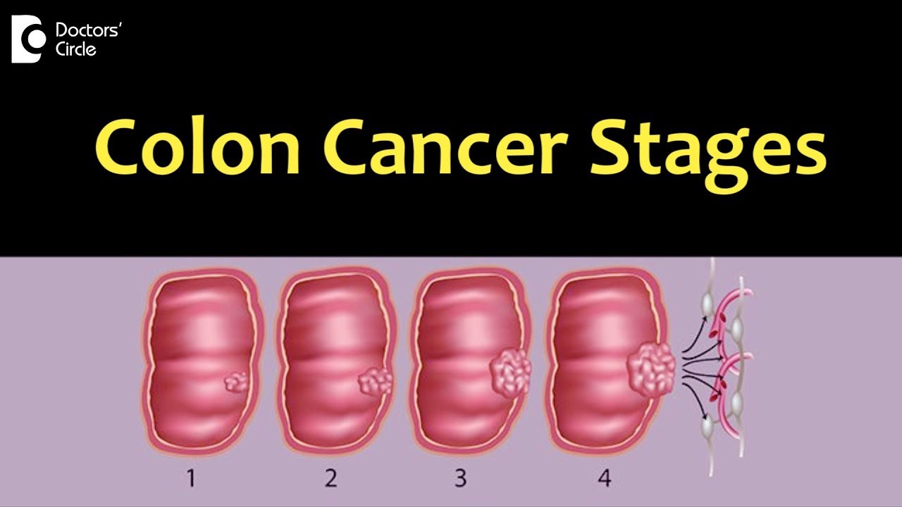 What are stages of colon cancer? - Dr. Parameshwara C M - YouTube