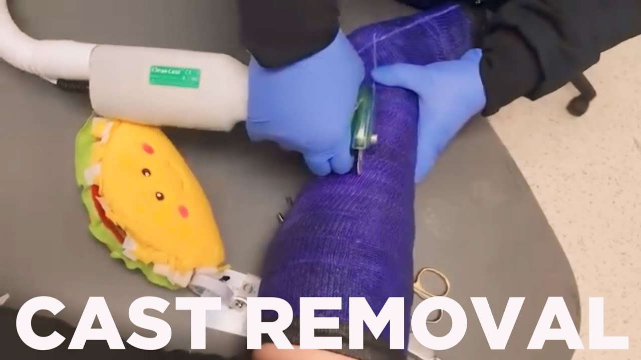 How Leg Cast is Removed | Ankle Fracture | Cast Removal Secrets - YouTube