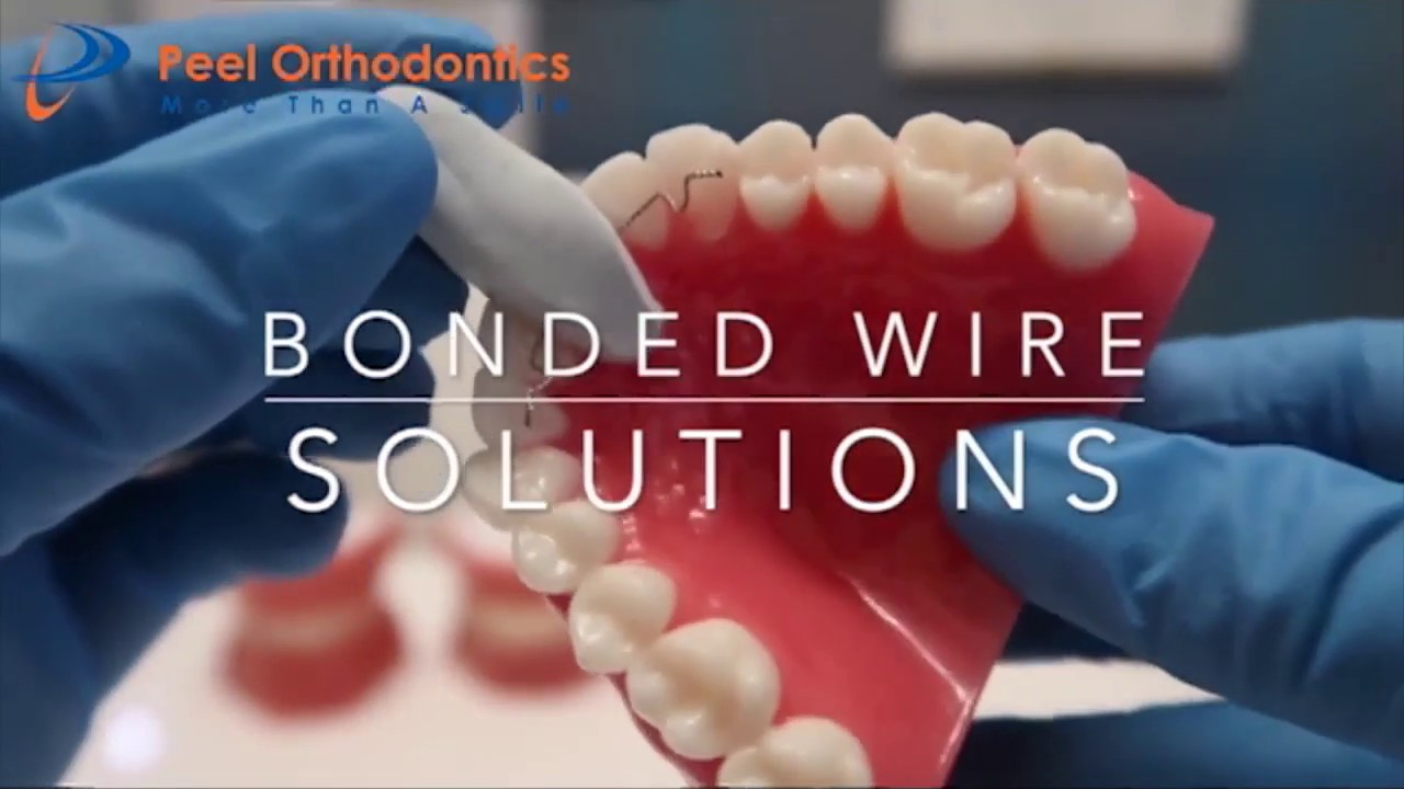Bonded retainer wire solution - YouTube