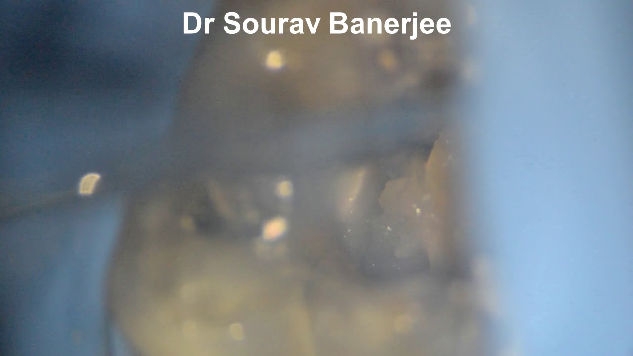 ENDO CONCEPT Pulp Stone Removal under Microscope - YouTube