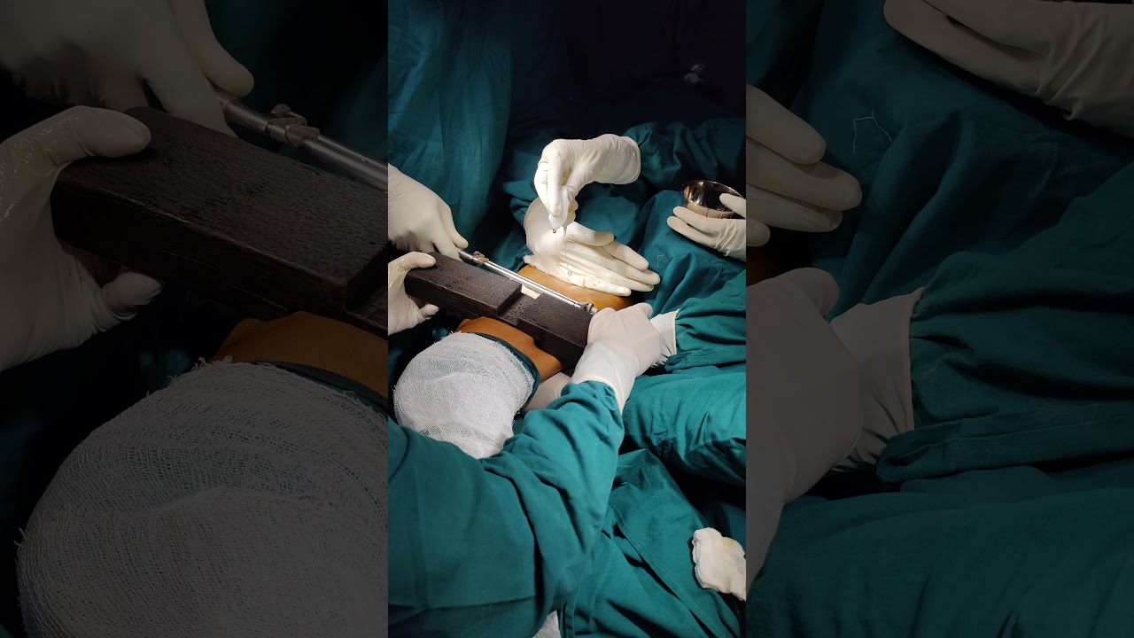 PLASTIC SURGERY | SPLIT SKIN GRAFT HARVEST USING HUMBY KNIFE - YouTube