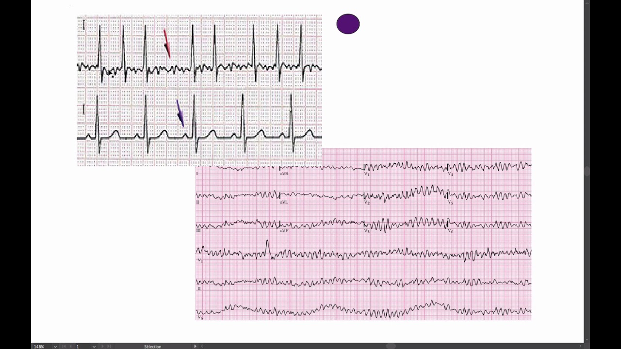 Exemples d'ECG pathologiques - YouTube