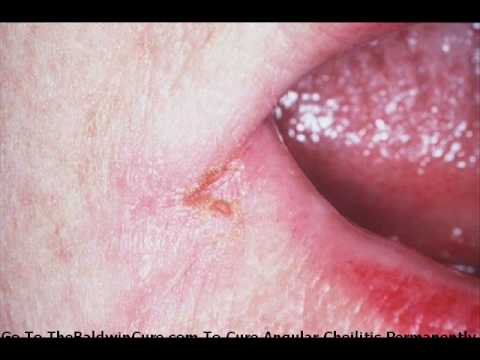 Angular Stomatitis Treatment and Causes - Cure Your Angular Stomatitis ...