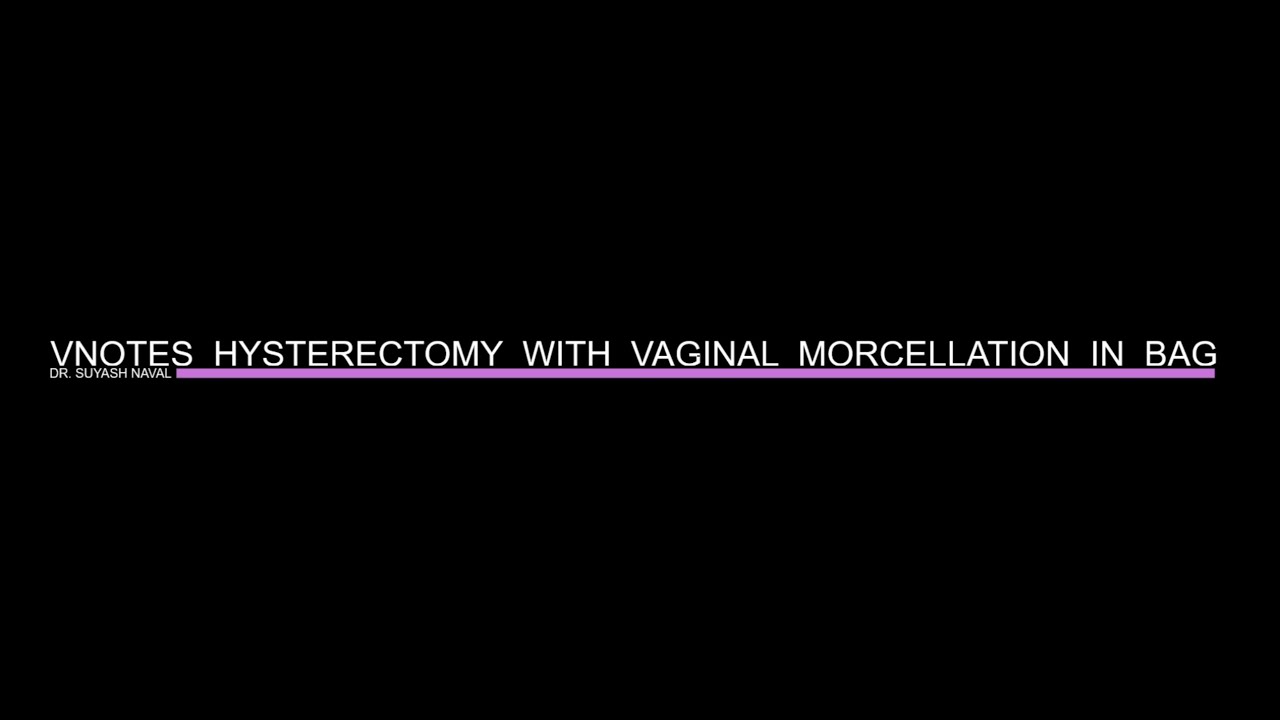 vNOTES Hysterectomy | Vaginal Morcellation In Bag | Adenomyosis ...