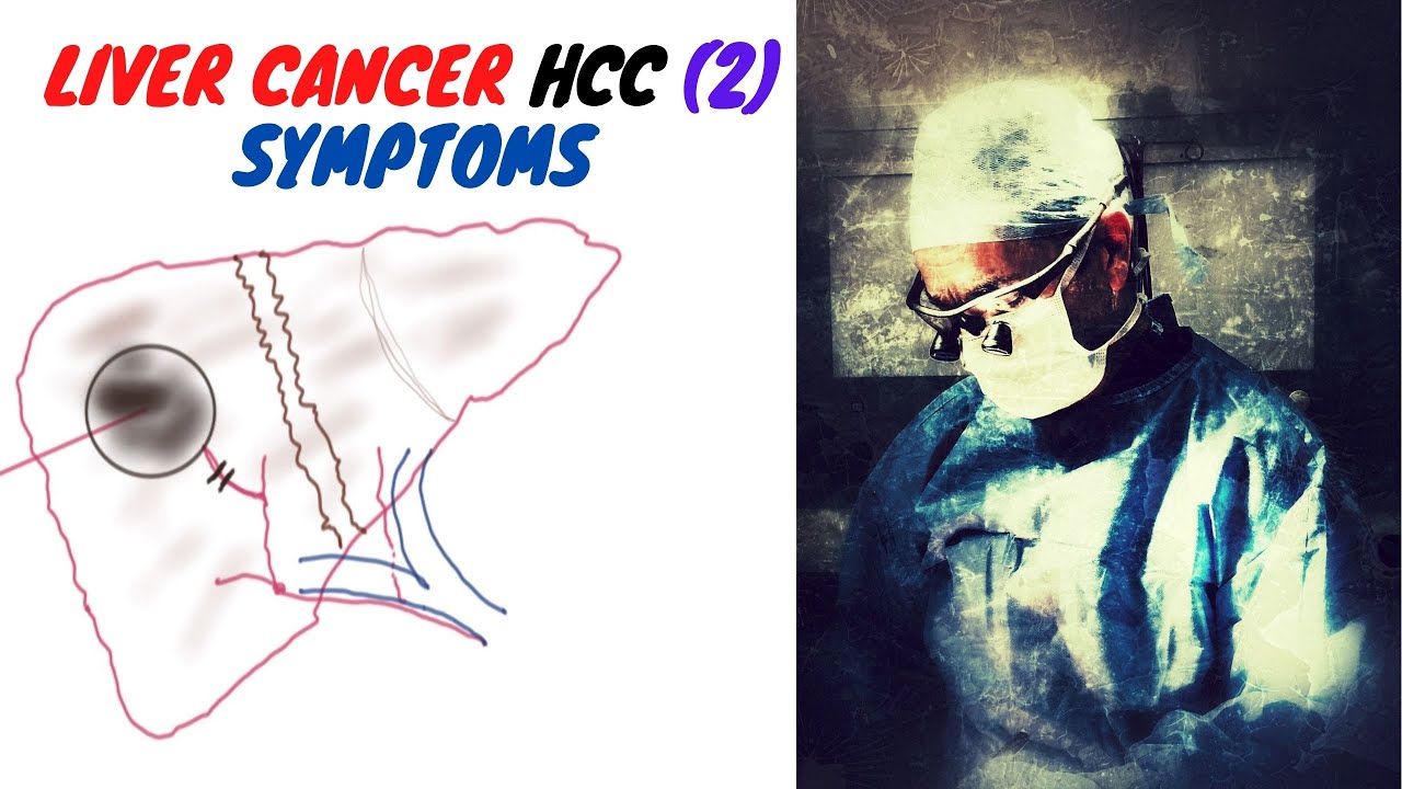 LIVER CANCER (HCC); Symptoms (2) - YouTube