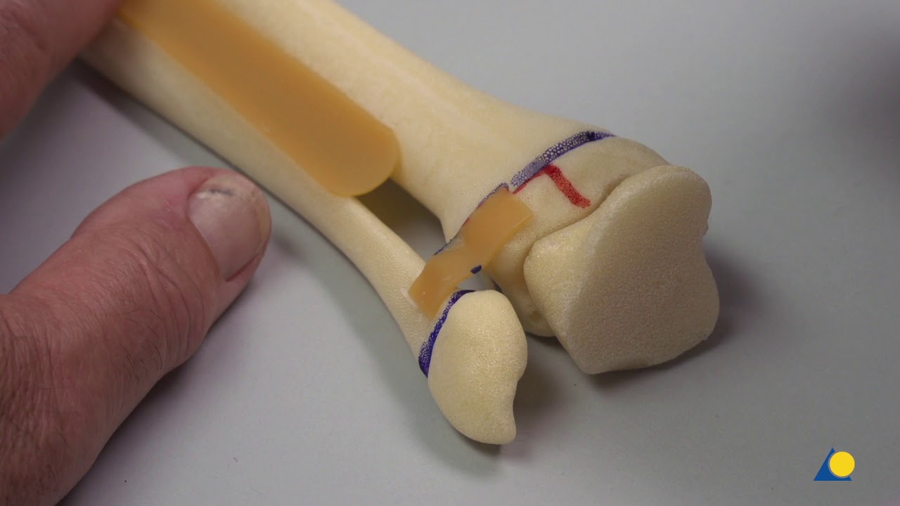 AO Trauma Tibia, Distal—Triplane Fracture Fixation - YouTube