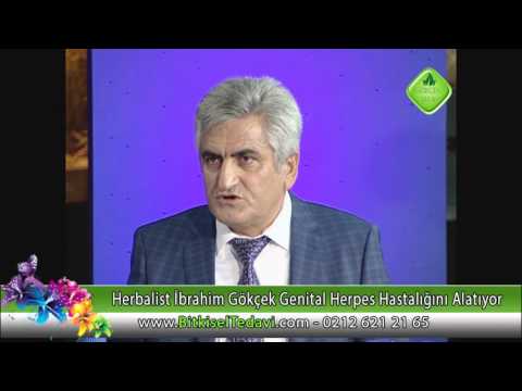 Genital Herpes Tedavisinde Yeni Çözümler, Melisa Forte ile Genital Herpes Tedavisi,