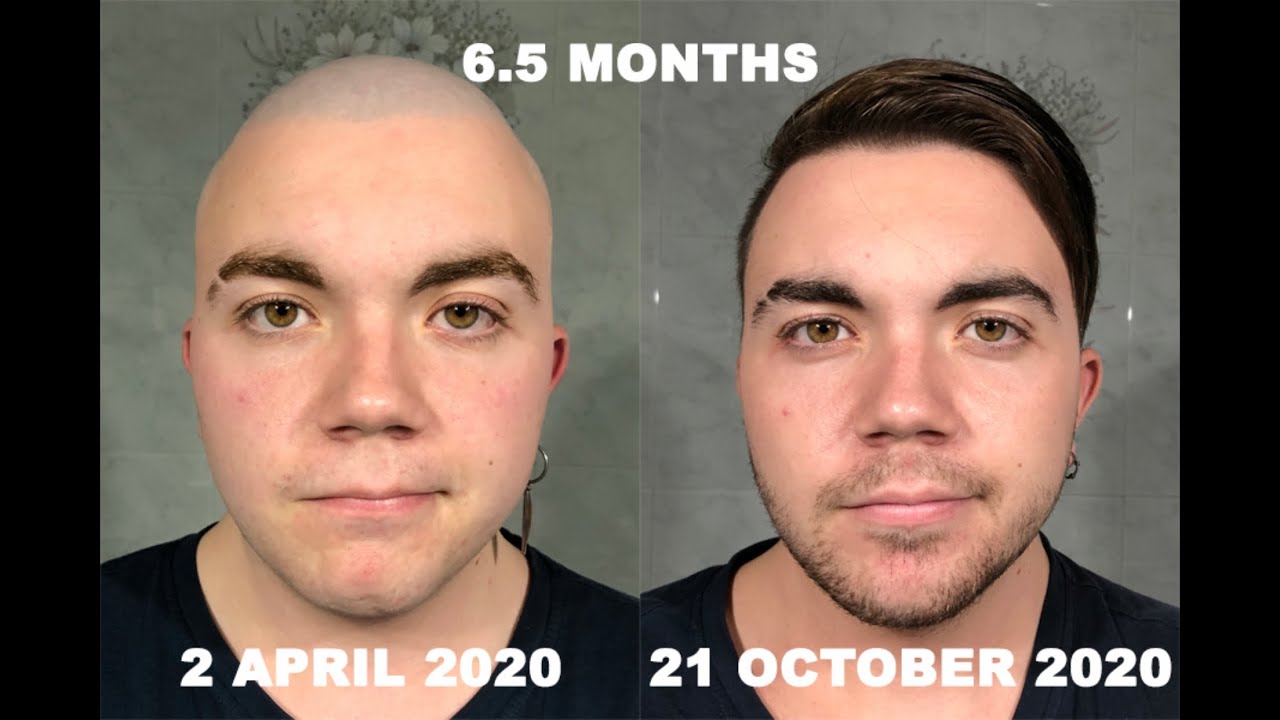 Hair growth time lapse - 6 months - YouTube
