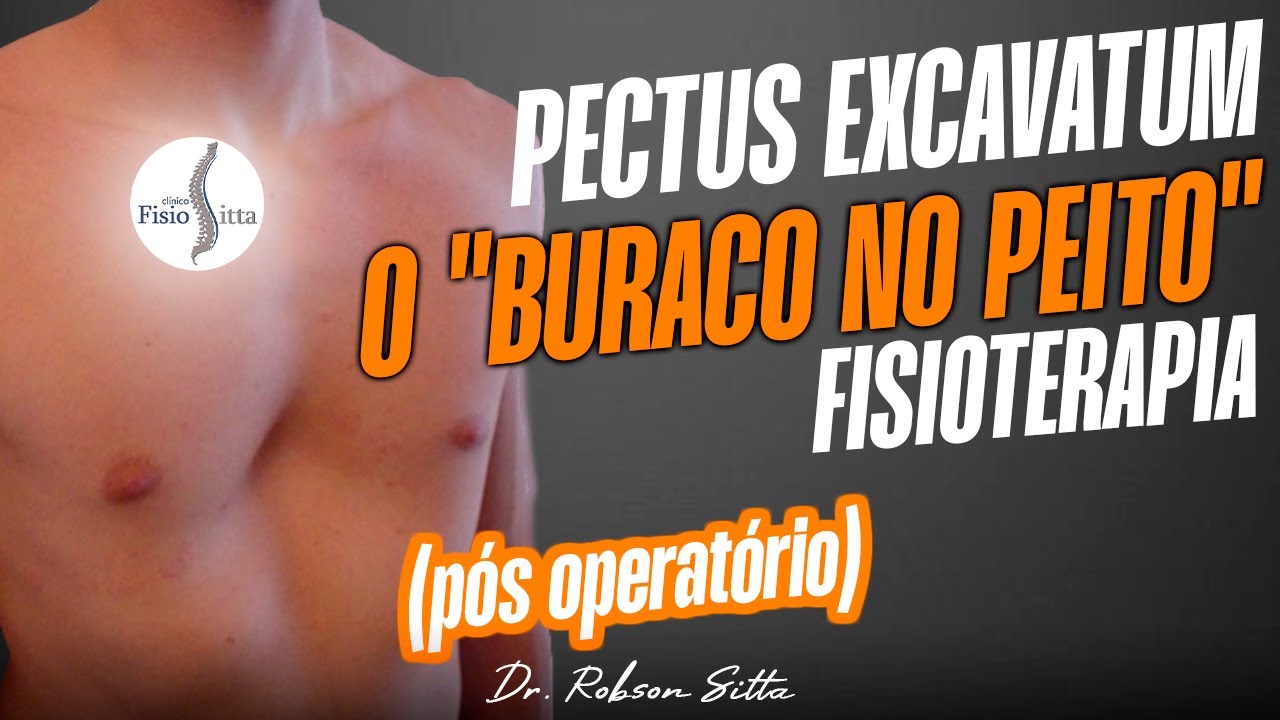 PECTUS EXCAVATUM ou PEITO ESCAVADO DEPRESSÃO NA CAIXA TORÁCICA PÓS ...