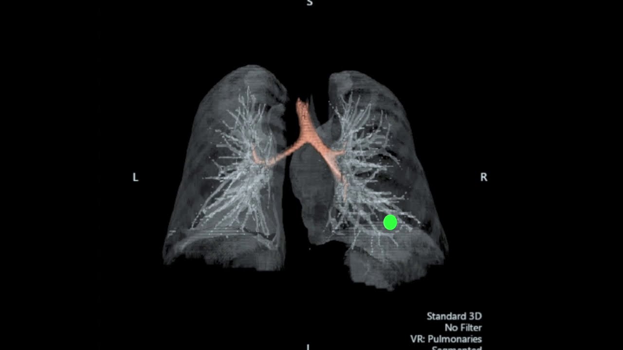 Robotic Right Lower Lobe Anteromedial Basilar (S7 + S8) Segmentectomy ...