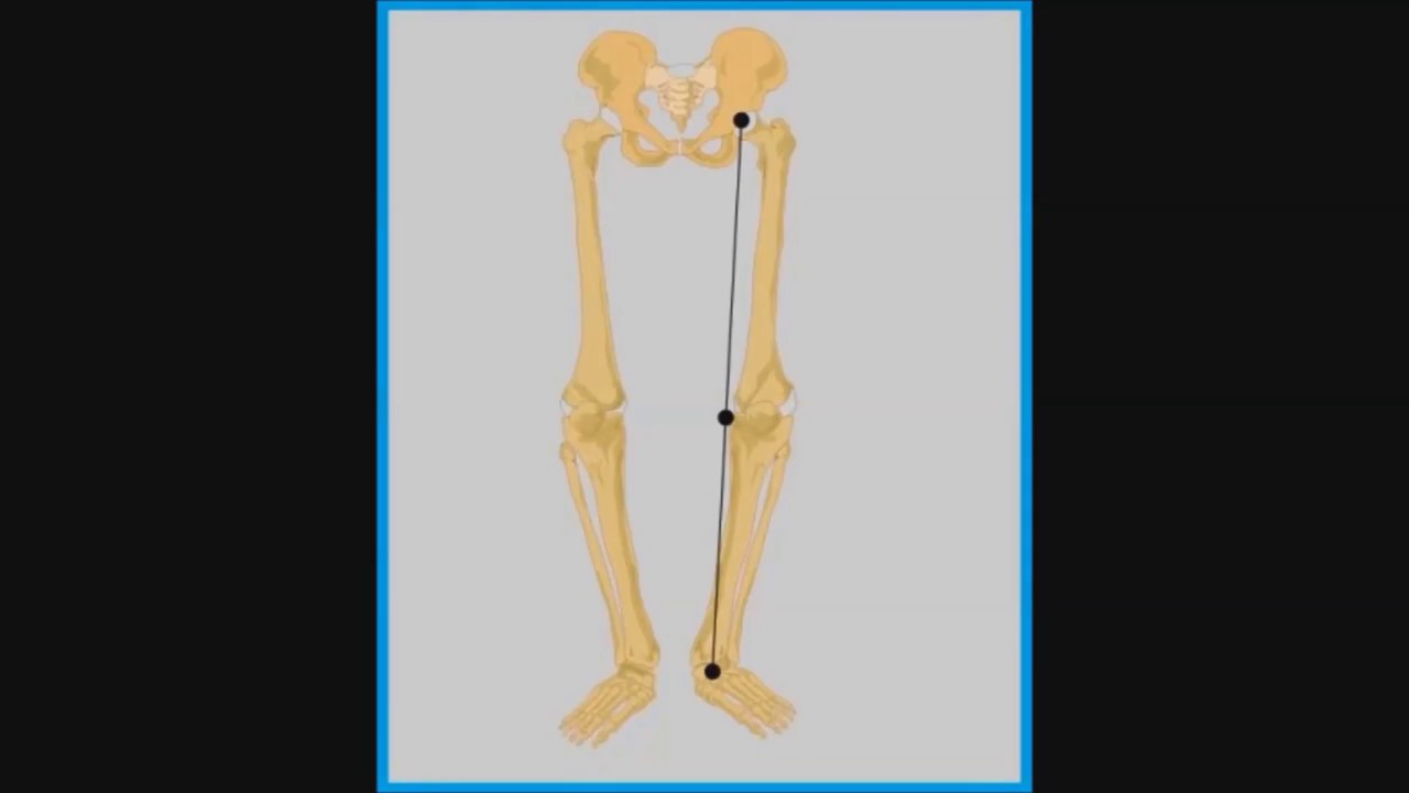 Osteotomia na tíbia I Retirada da placa Puddu. - YouTube