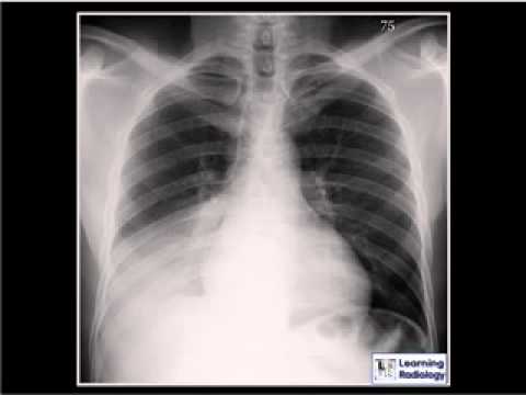 El signo de la Silueta - YouTube