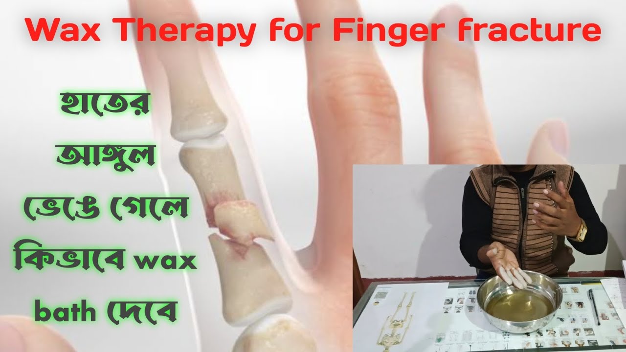 Wax Therapy for finger fracture - YouTube