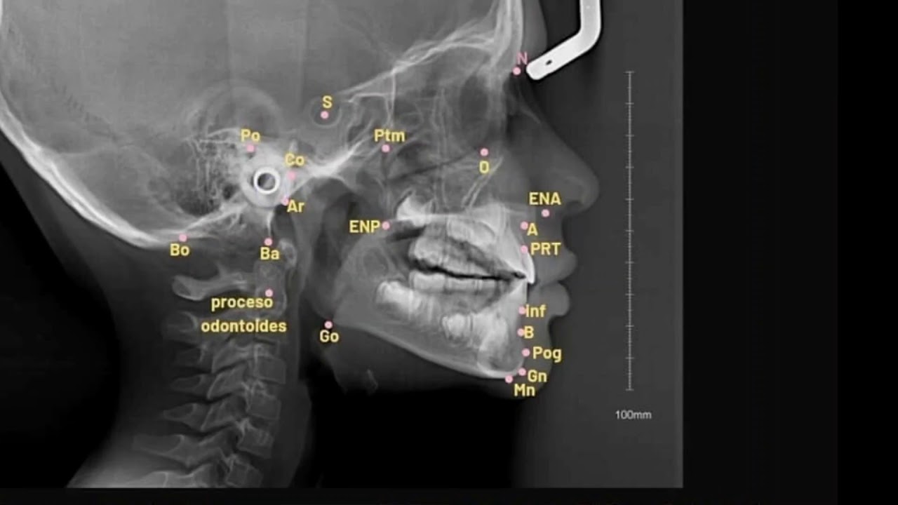 Cephalometric analysis | Tracing | بالعربي - YouTube