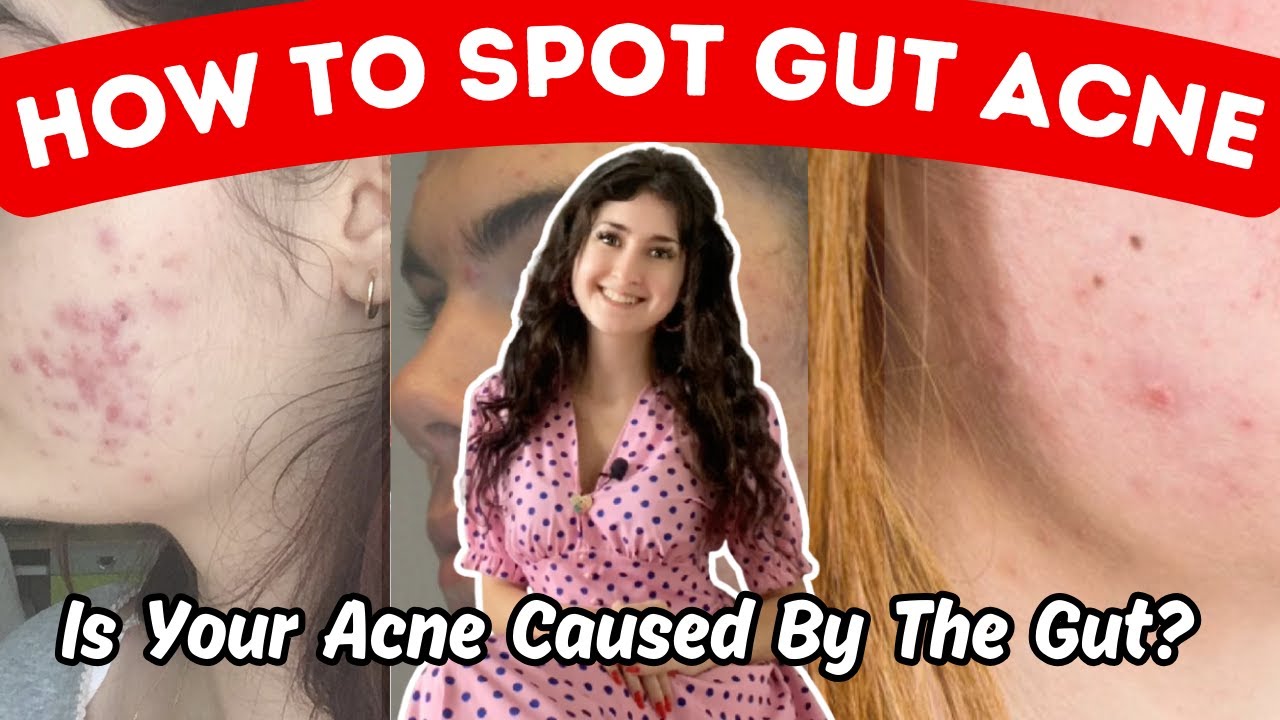 6 GUT ACNE SIGNS & SYMPTOMS (The Gut Acne Connection & How To Heal Your ...