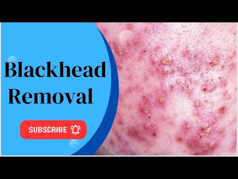 Pimples and pustules removal - YouTube