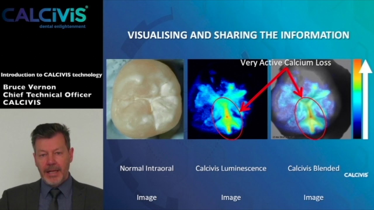 CTO Bruce Vernon | Introducing CALCiViS Technology - YouTube