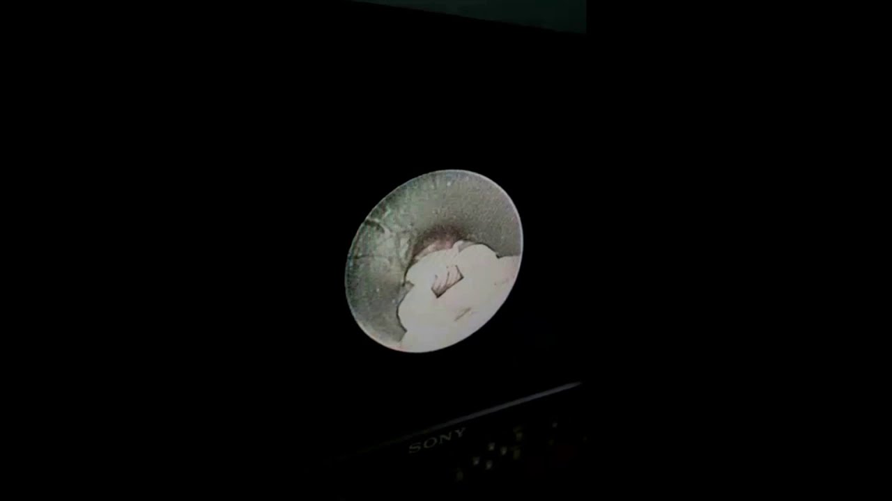 F. BODY BRONCHUS SCREW RIGID BRONCHOSCOPY Dr SUDESH CONSULTANT ENT ...