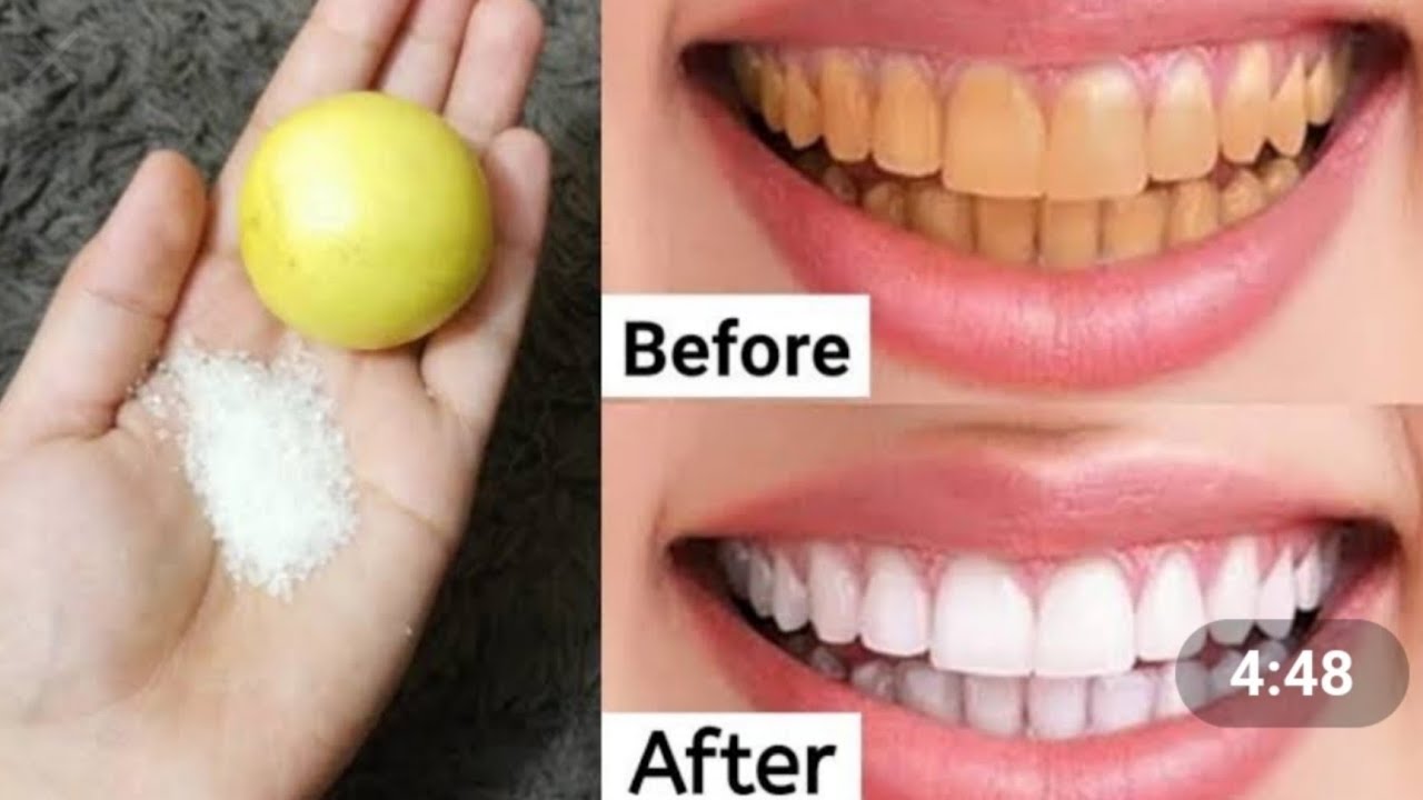 PEARL TEETH WHITENING AT HOME||Teeth scaling remedy||100% effective ...