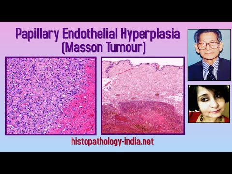 Pathology of Papillary Endothelial Hyperplasia (Masson Tumour) by Dr ...