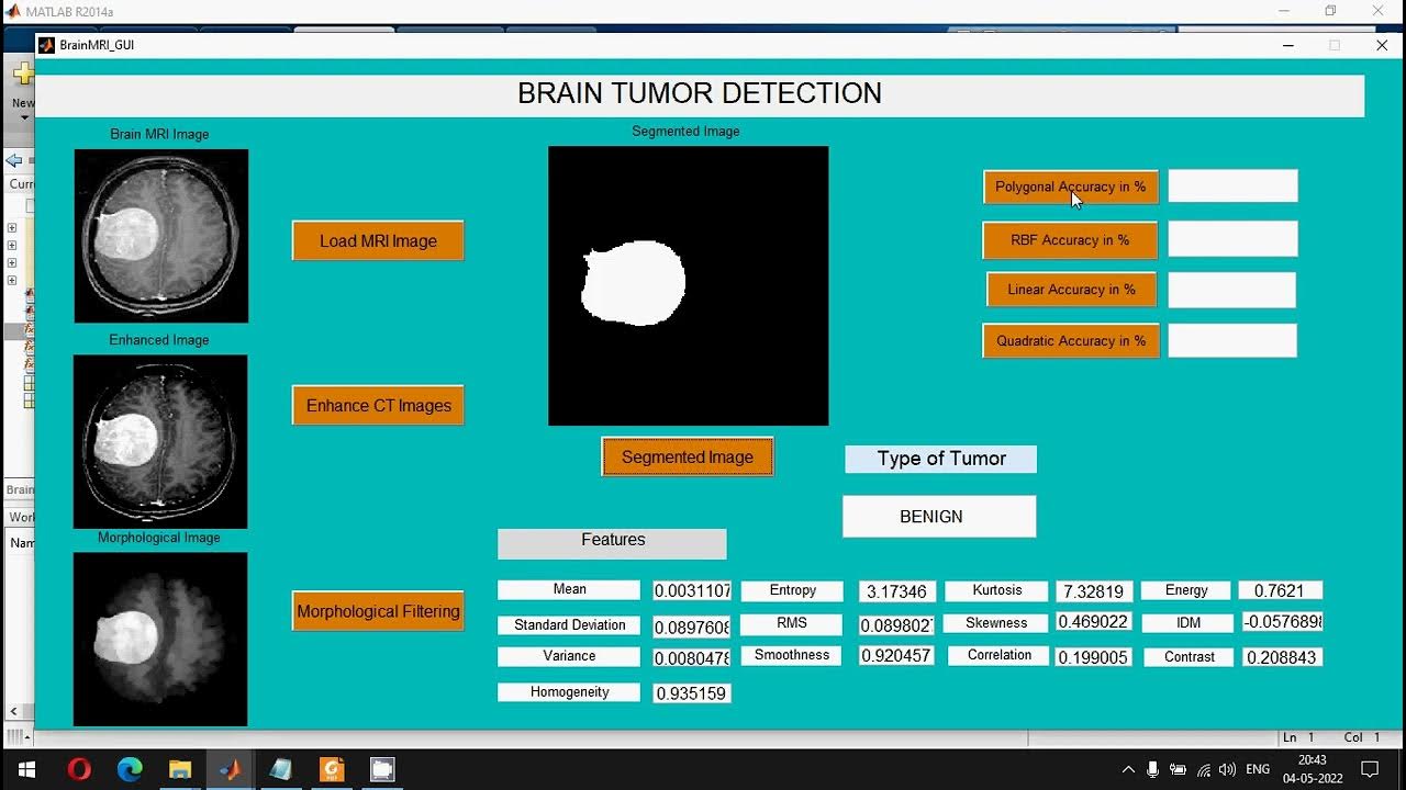 Brain Tumor Detection Using Svm Classifier Matlab Youtube