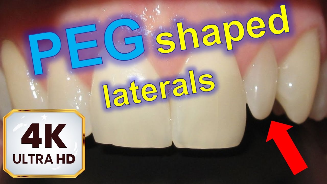 ️‍🔥 Dental IMPLANT, PEG shaped laterals and MIDLINE shifting timelapse ...