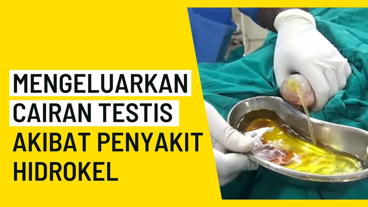 Mengeluarkan Cairan Testis Akibat Penyakit Hidrokel - YouTube