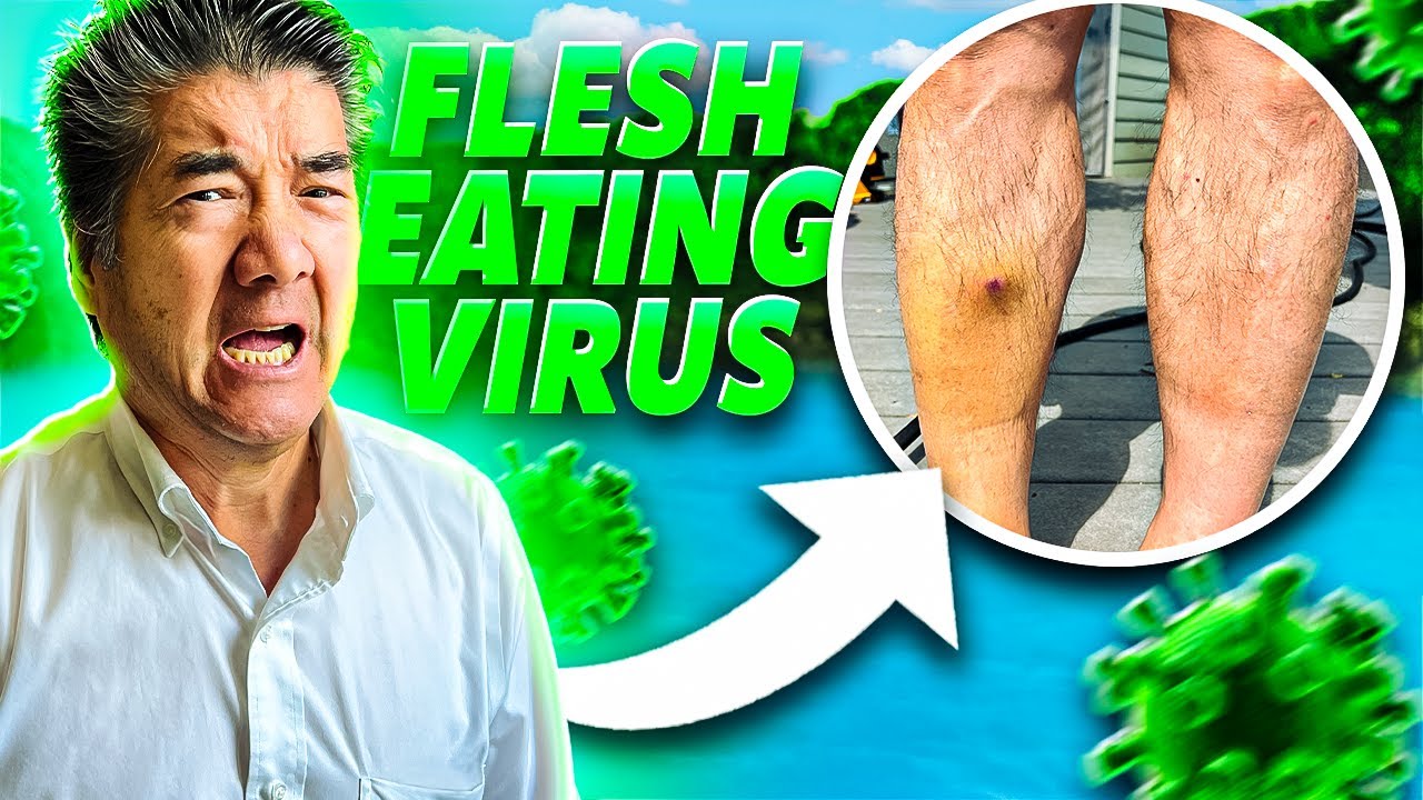 My Dad got a FLESH EATING VIRUS while River Fishing!! (WATCH TO THE END ...