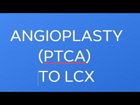 Angioplasty(PTCA) to LCX|Stenting|#cathlab #angioplasty - YouTube