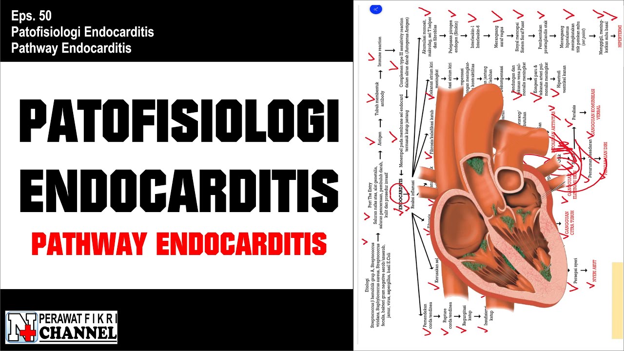 Patofisiologi Endocarditis I Pathway Endocarditis I Download File Cek ...
