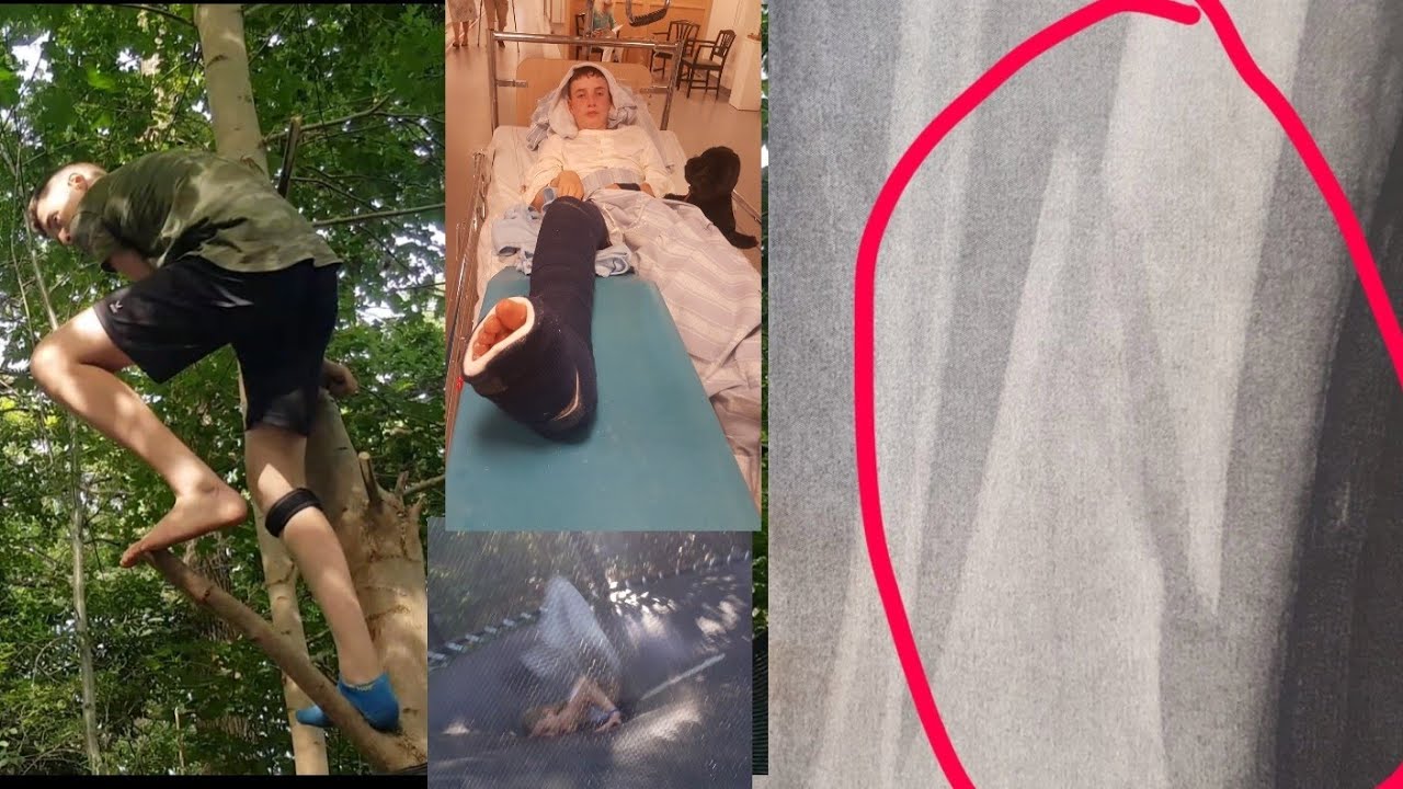 New trampoline! broken leg* scropions and more! - YouTube