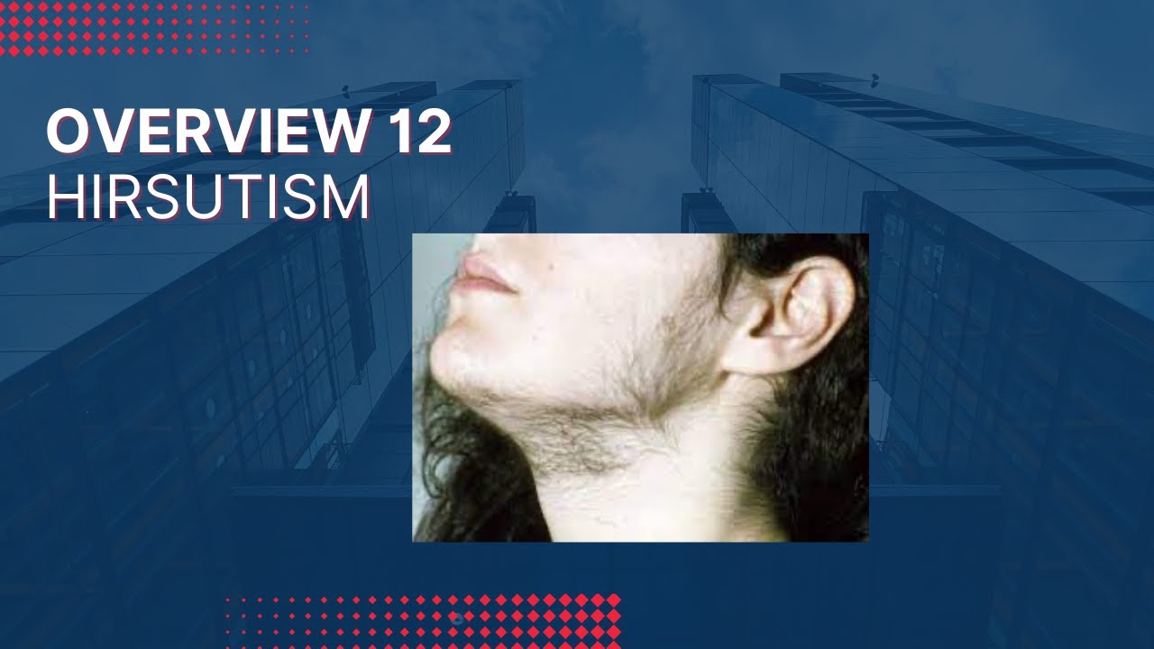 Overview 12 : Hirsutism - YouTube