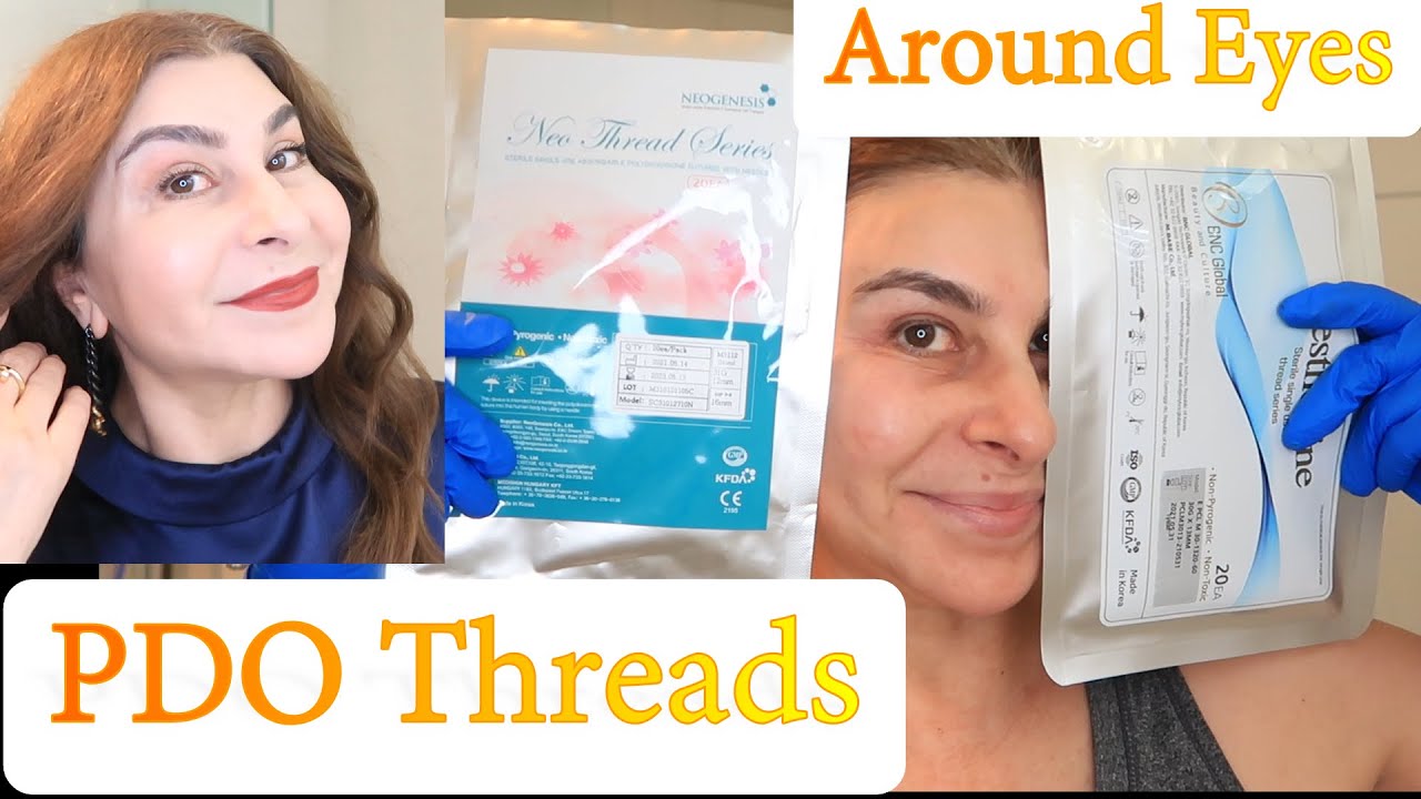 PDO Threads Around Eyes to fight Dark Circles, Bags and Wrincles | PDO ...