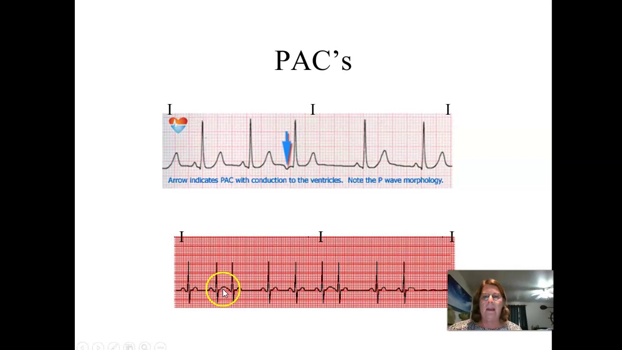 Atrial Rhythms part 1 - YouTube