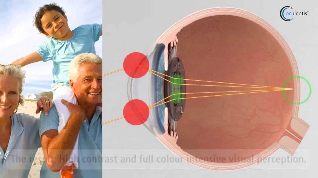 - OCULENTIS Mplus - - YouTube