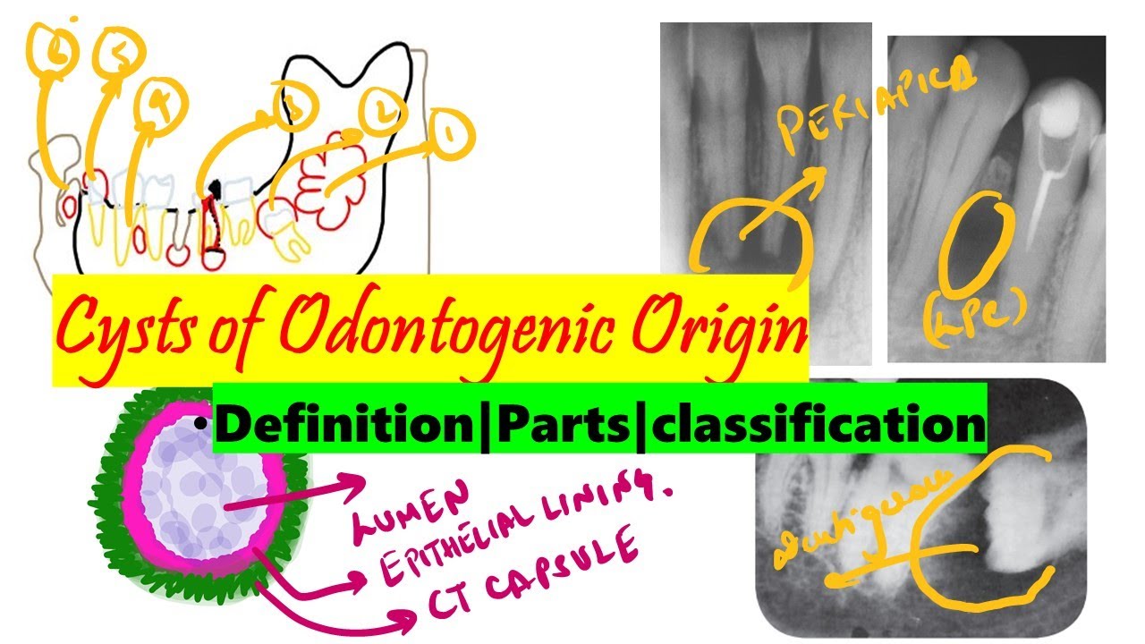 Cysts of Odontogenic origin | DETAILED Introduction | Parts ...