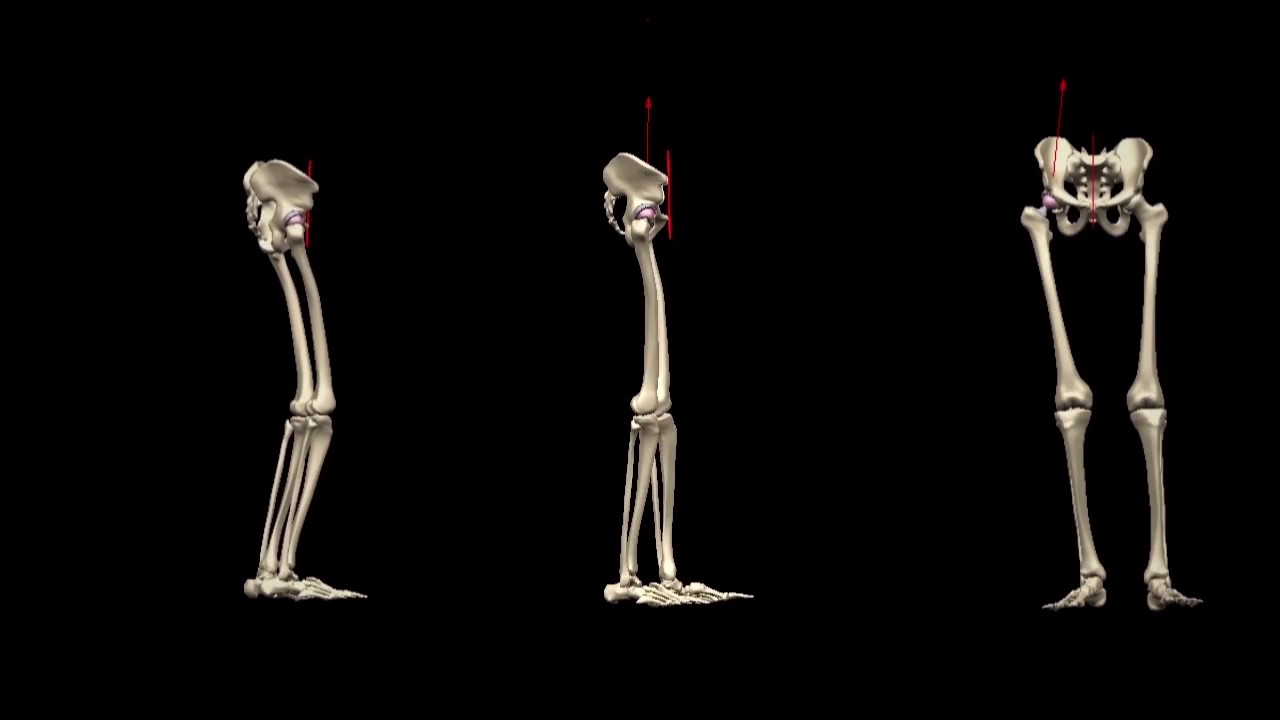 Corin OPS, manufactured and submitted by Optimized Ortho Australia ...